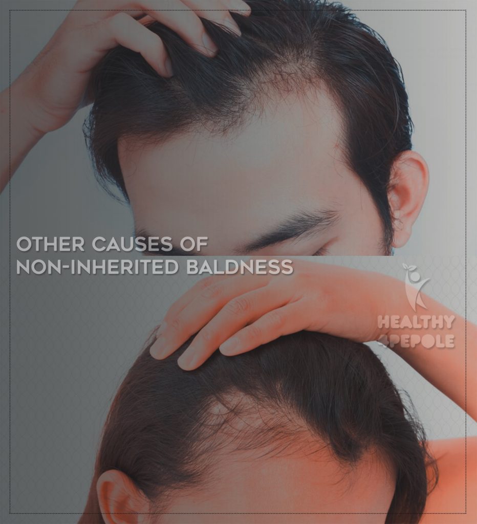Other causes of non-inherited baldness – Healthy4Pepole